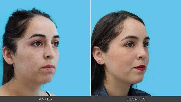 Aumento de mentón - Clínica La Parva - Santiago, Chile