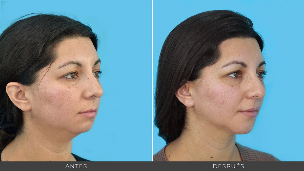 Aumento de Mentón para Mejorar tu Perfil Facial | Clínica La Parva