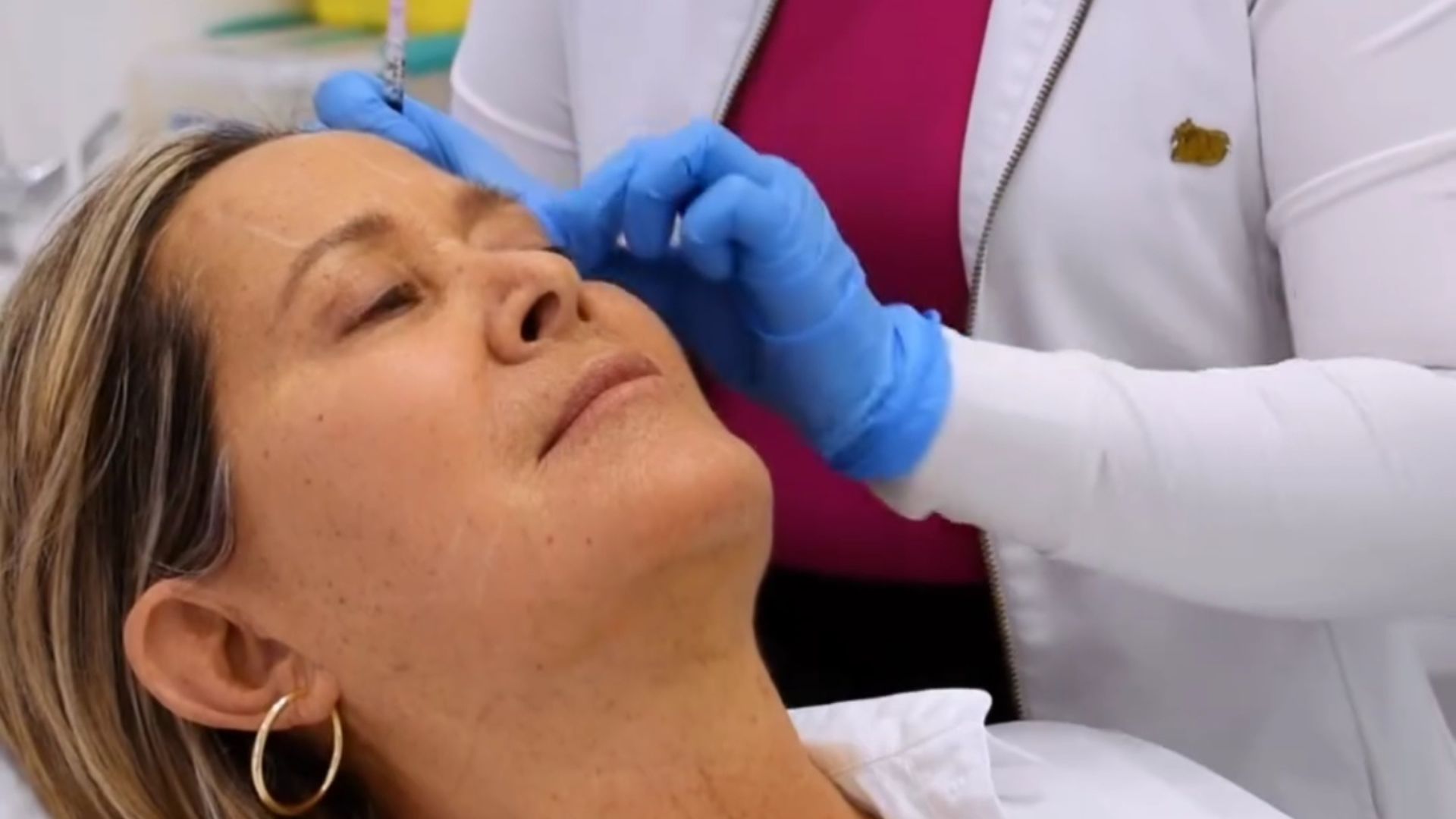 Hifu y Bótox: la dupla perfecta